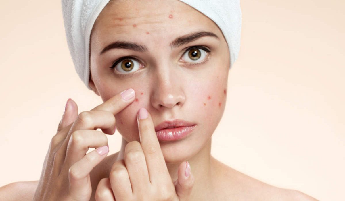 3 easy tips to reduce teenage acne – fashionwire.co